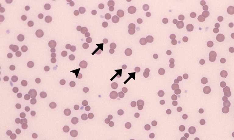 Spherocytes – Cells and Smears