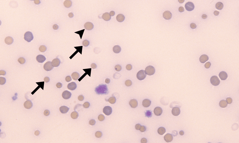 Spherocytes – Cells and Smears