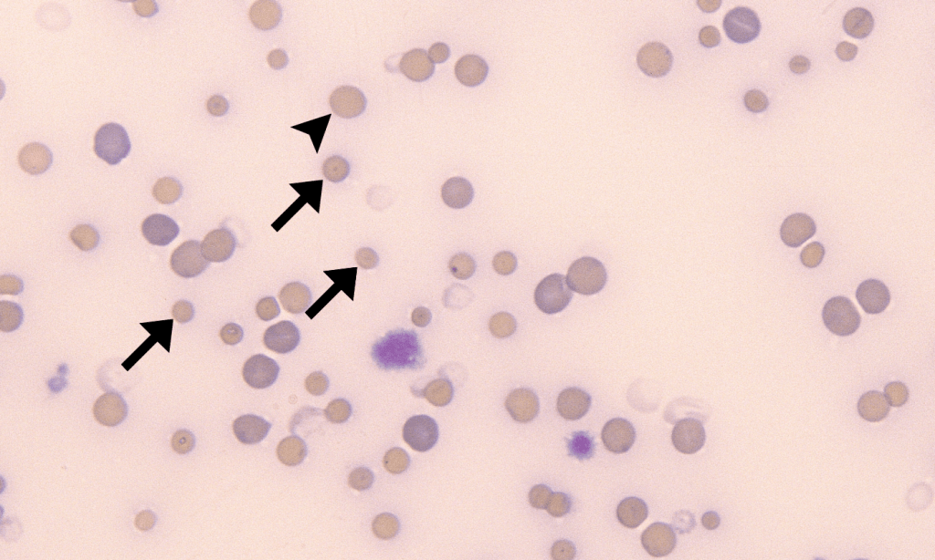 Spherocytes – Cells and Smears