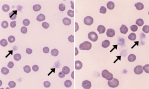Normal Platelets – Cells and Smears