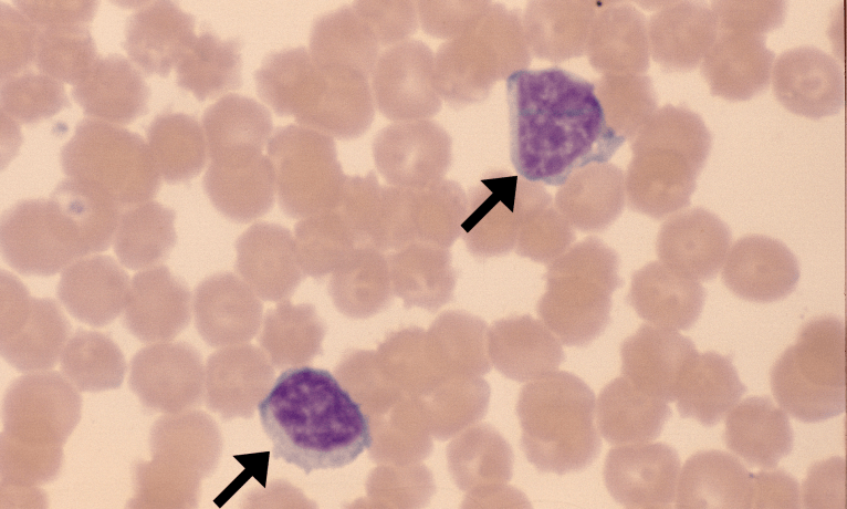 CLL – Cells and Smears