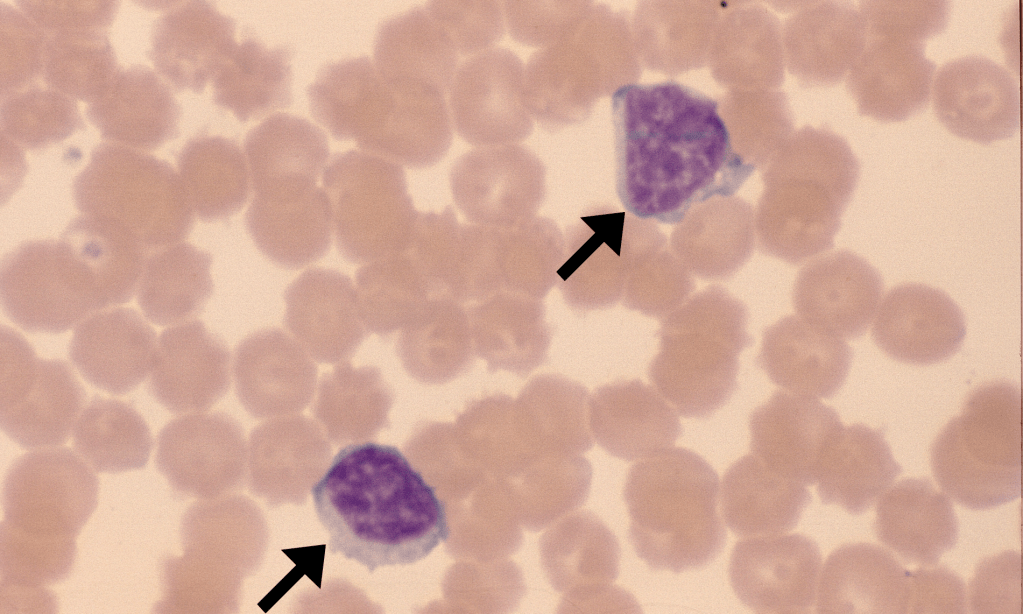 CLL – Cells and Smears