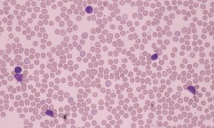 CLL – Cells and Smears