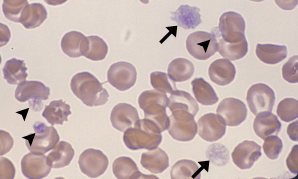 Giant Platelet – Cells and Smears