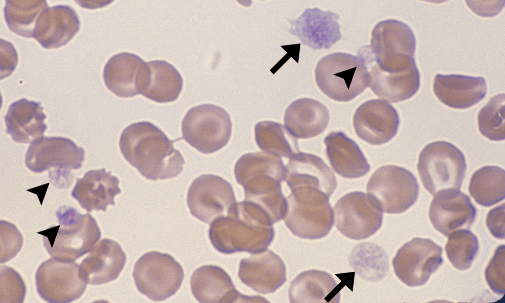 Giant Platelet – Cells and Smears