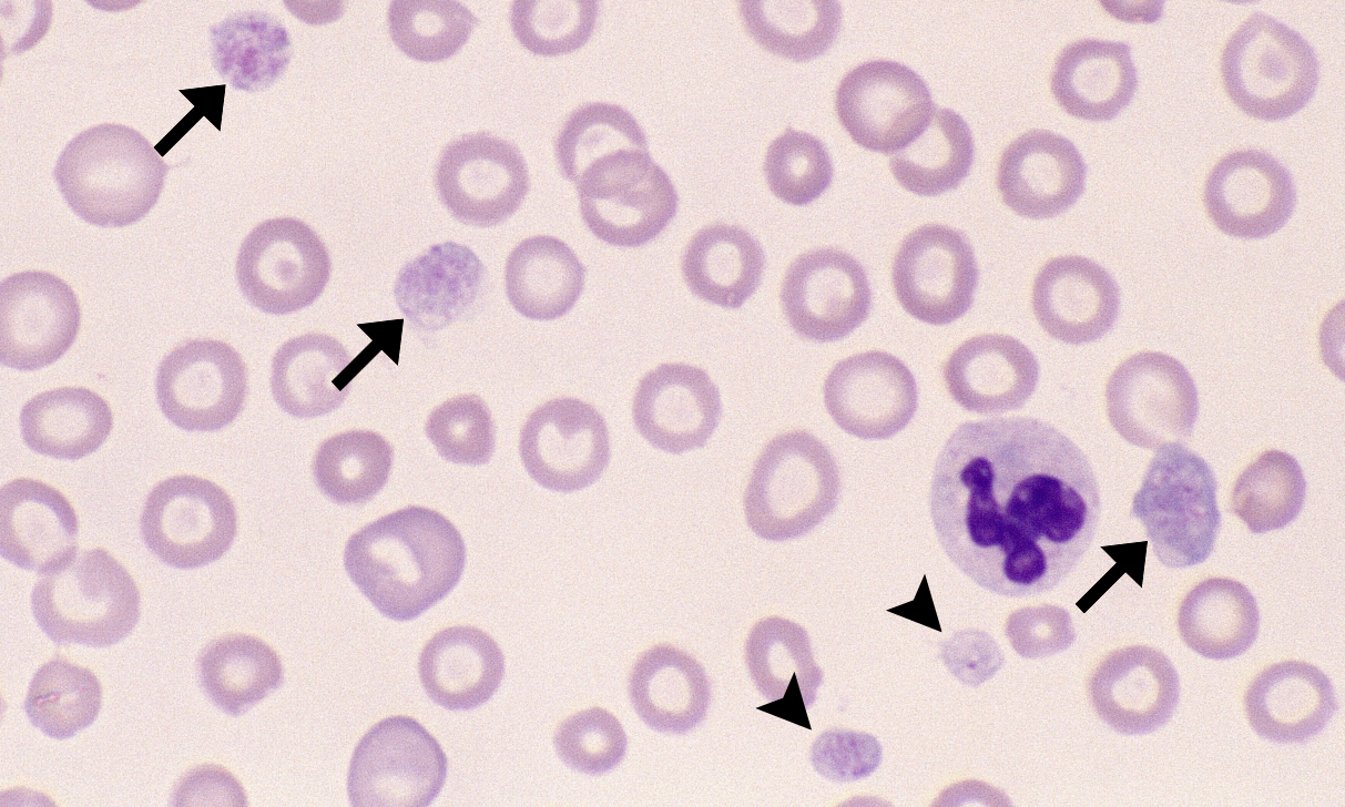 Giant Platelet – Cells and Smears