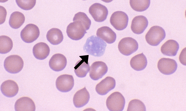 Giant Platelet – Cells and Smears