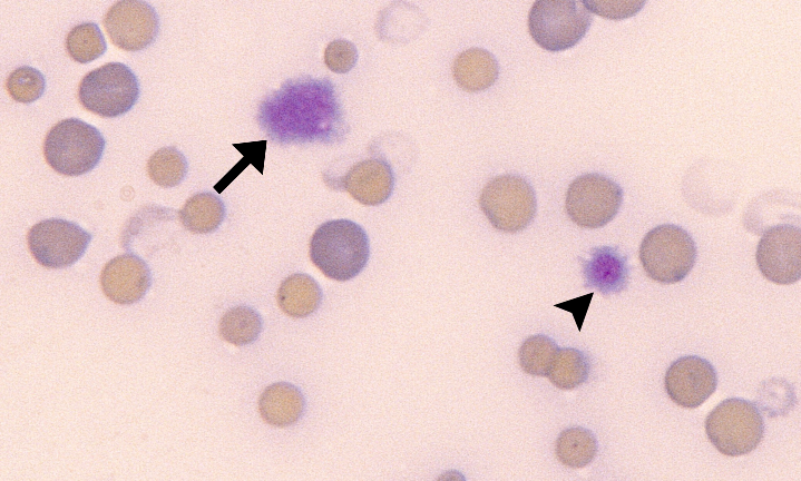 Giant Platelet – Cells and Smears
