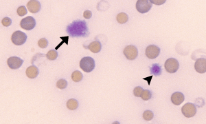 Giant Platelet – Cells and Smears