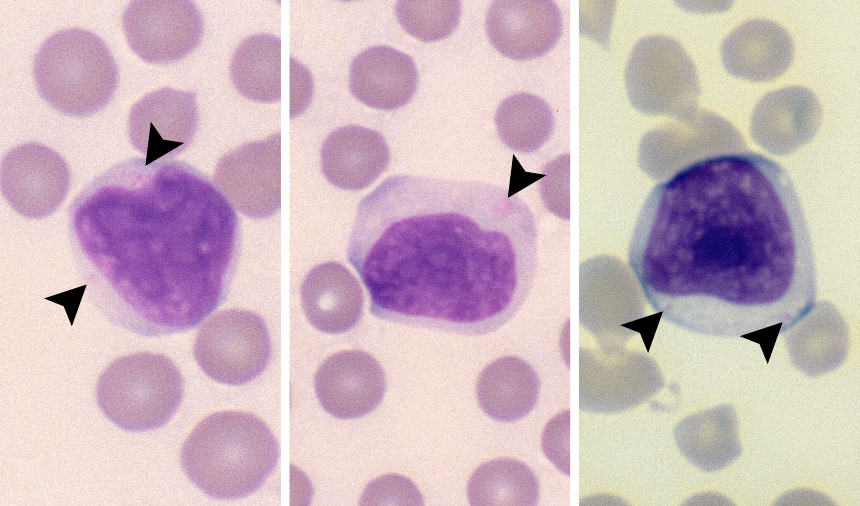 Granular Lymphocytes – Cells and Smears