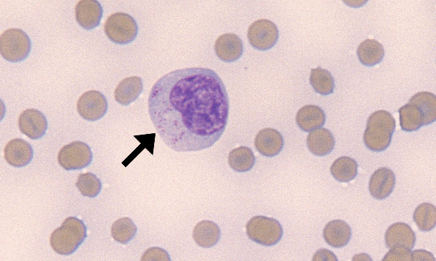 Granular Lymphocytes – Cells and Smears