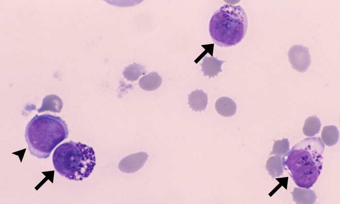 Histopathology Images Of Large Granular Lymphocytic Lgl