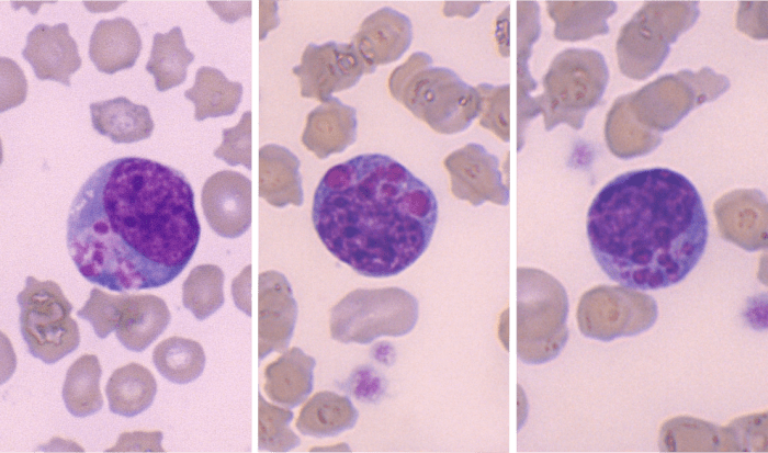 Granular Lymphocytes – Cells and Smears