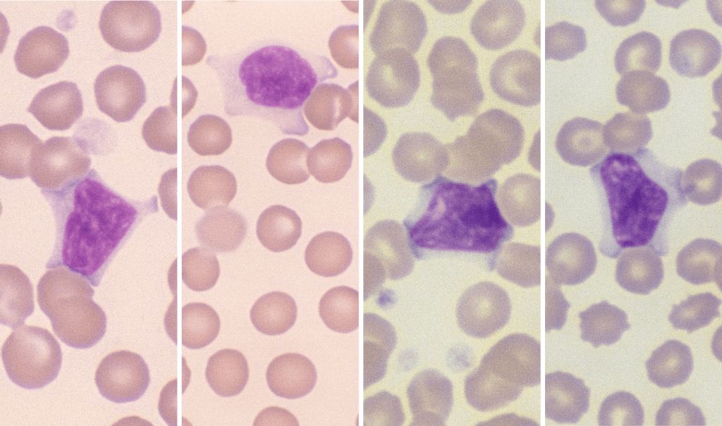 Mature Lymphocytes – Cells and Smears