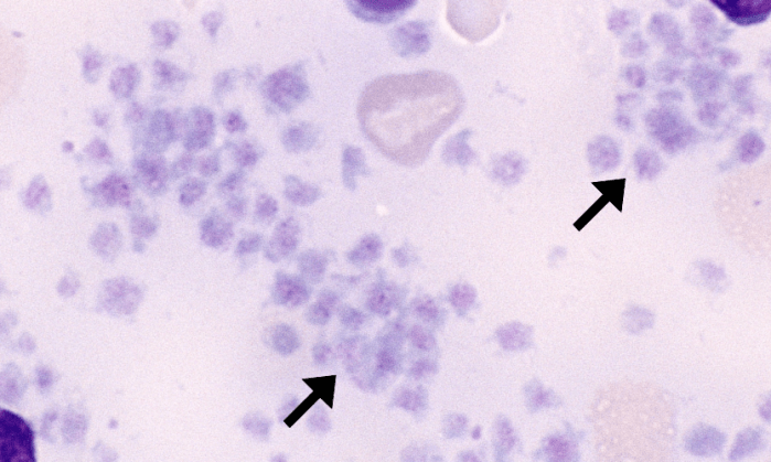 Platelet Clumps – Cells and Smears
