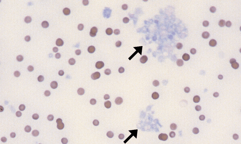 Platelet Clumps – Cells and Smears