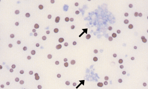 Platelet Clumps – Cells and Smears