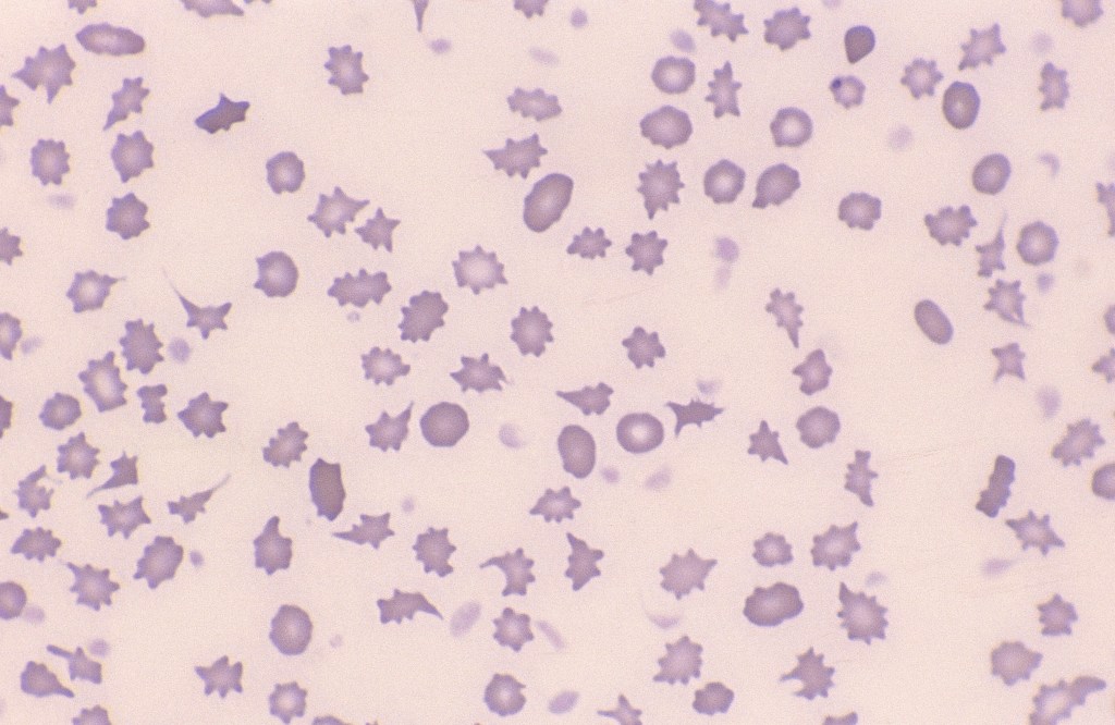 poikilocytosis – Cells and Smears
