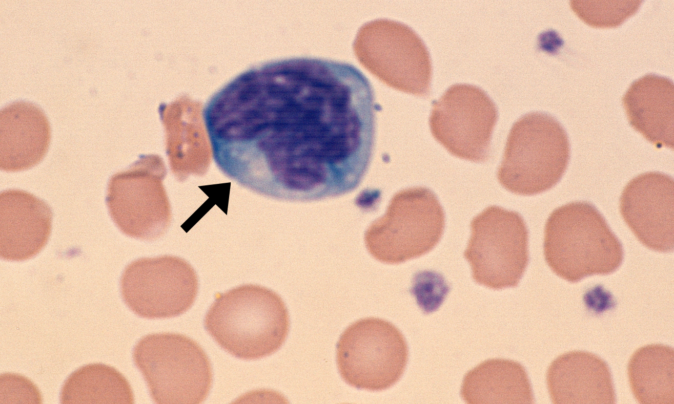 Reactive Lymphocytes – Cells and Smears