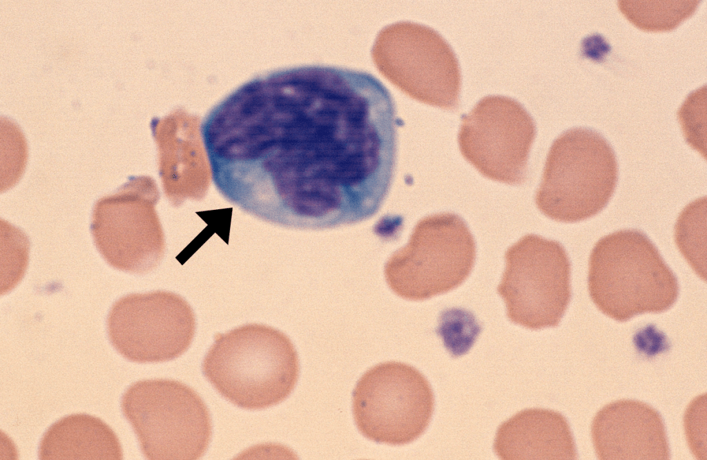 lymphocytes – Cells and Smears