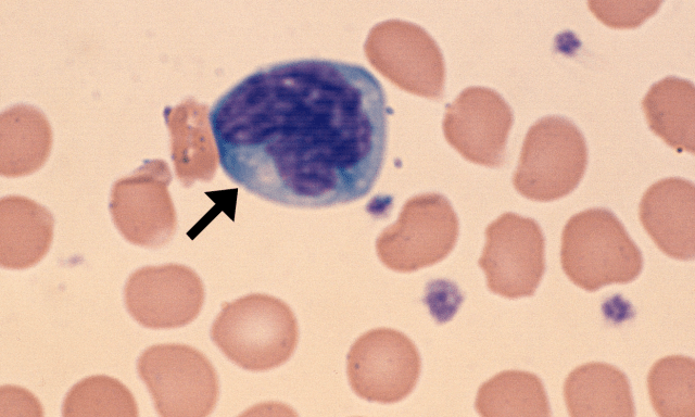 Reactive Lymphocyte Atypical Lymphoid Cells Circulating In Blood In