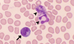 Reactive Lymphocytes – Cells and Smears