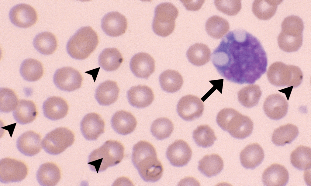 Reactive Lymphocytes – Cells and Smears