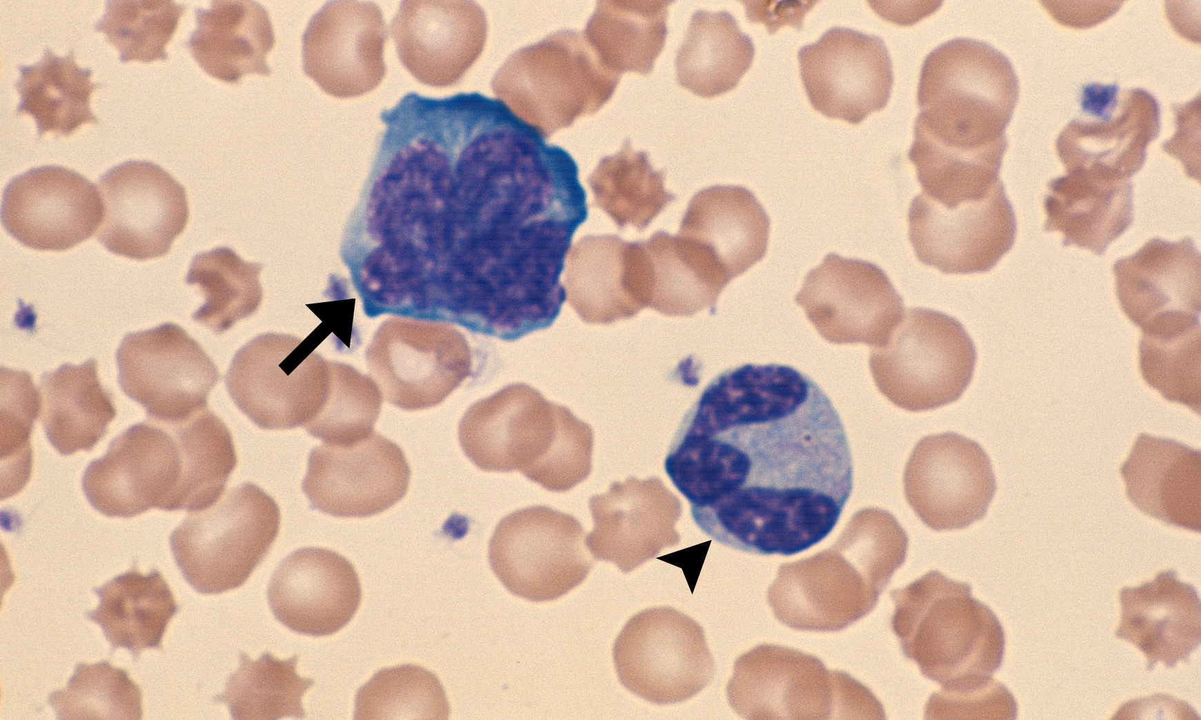 Reactive Lymphocytes – Cells and Smears