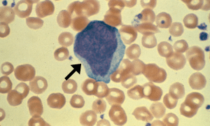 Reactive Lymphocytes – Cells and Smears